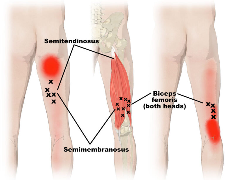 Hamstring Trigger Points & Release Techniques - The Ached Body